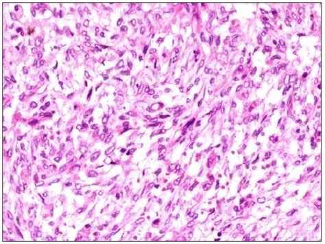 Bcor Overexpression In Pediatric Sarcomas A Morphologic Continuum Of Mixed Round And Spindle
