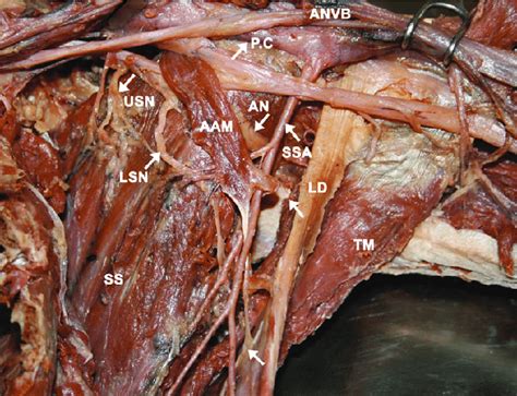 Subscapularis Cadaver