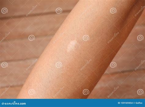 A Scar On Woman Hand Stock Photo Image Of Person Hand