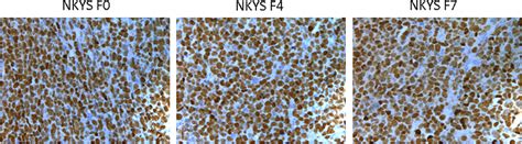 Ebv Was Strongly Detected In Situ Hybridization For Ebv Rna Using The Download Scientific