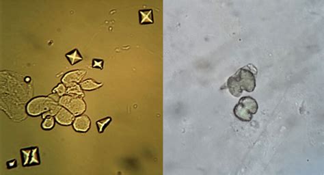 Calcium Oxalate Crystals Nephrology In 30 Days
