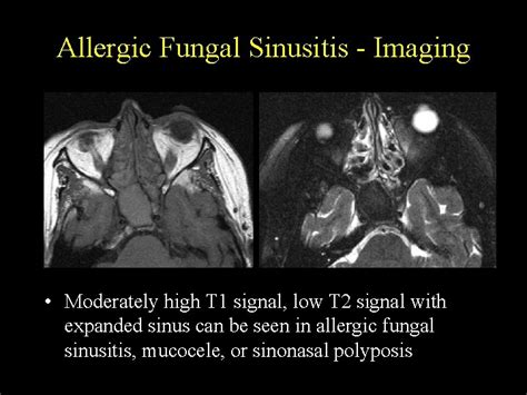 Fungal Sinusitis An Overview Cade Martin Md Fungal