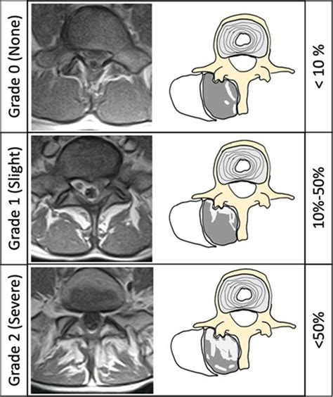 Bilateral Lower Motor Neuron Nerve Palsy Cpt Code