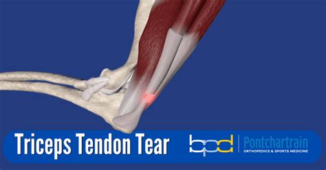 Triceps Tendon Triceps Tendonitis Tendinopathy Is An Overuse Injury