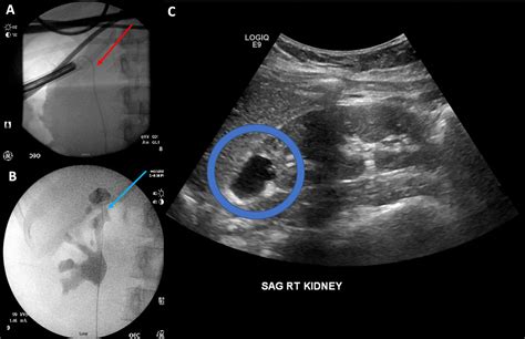 Frontiers Percutaneous Endoscopic Creation Of A Neoinfundibulum For A