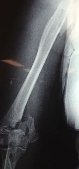 O R T O C R I T I C A Fractura Segmentaria De Humero En Paciente Mayor