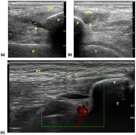 Common Ultrasonographic Findings Of Knee In Surveyed Athletes A Download Scientific Diagram