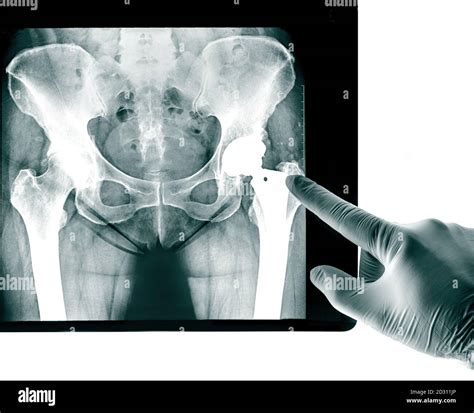 X Ray Of The Pelvis Endoprosthesis The Socket Of The Hip Joint Used