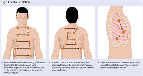 Right Lateral Chest Wall Chest Xray Interpretation In Icu Deranged