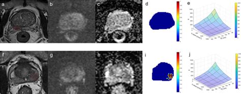 Detection Of Prostate Cancer Using Diffusion Relaxation Correlation