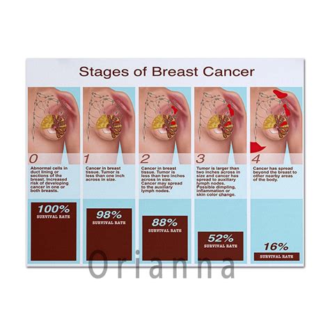 Breast Cancer Diagram Stages