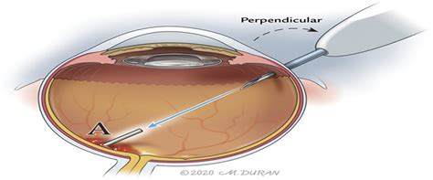 Dexamethasone Intravitreal Implant Complications Including V Retinal Cases And Brief Reports