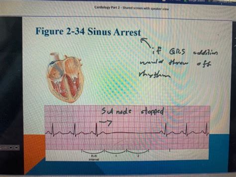 Cardiac Strips And Rhythms Flashcards Quizlet