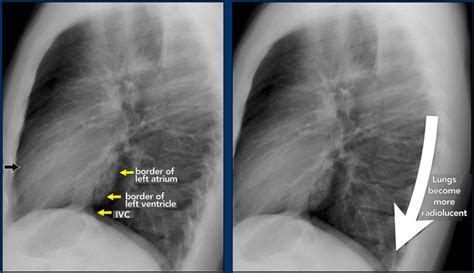 Normal Lateral Chest Xray Cystic Fibrosis Lateral Chest X Ray