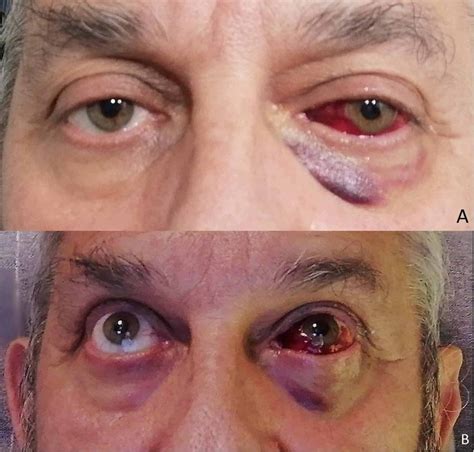 After 48 Hours Orbital Conjunctival Hemorrhage Hematoma Download