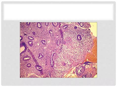 Genital Tuberclosis And Infertilty Ppt