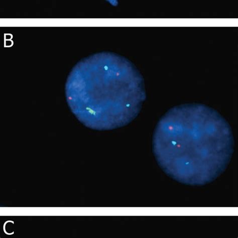 Fish Of Interphase Cells And Mitotic Lymphocytes With Different Probes