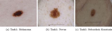 Examples Of Dermoscopic Images Download Scientific Diagram