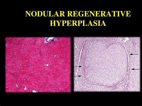 Ppt Hepatic Complications Of Ibd Powerpoint Presentation Id4918