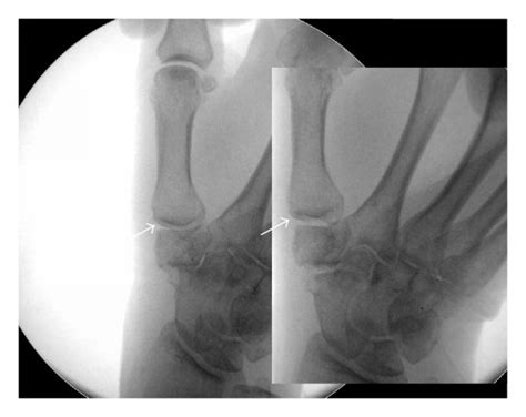 A Anteroposterior And Lateral X Rays Of The Right Tmc Joint Of A Download Scientific Diagram