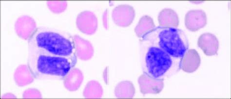 Lymphocytes Binucléés Caractéristiques Observés Au Cours Dune