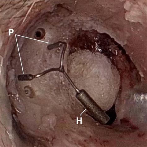 Insertion Of Malleus Replacement Prosthesis A Middle Ear And Ossicles Download Scientific