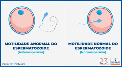 Motilidade Dos Espermatozoides Motilidade Normal E Baixa Explicada