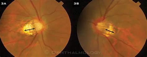 Myopia And Glaucoma Sorting Out The Diagnosis American Academy Of