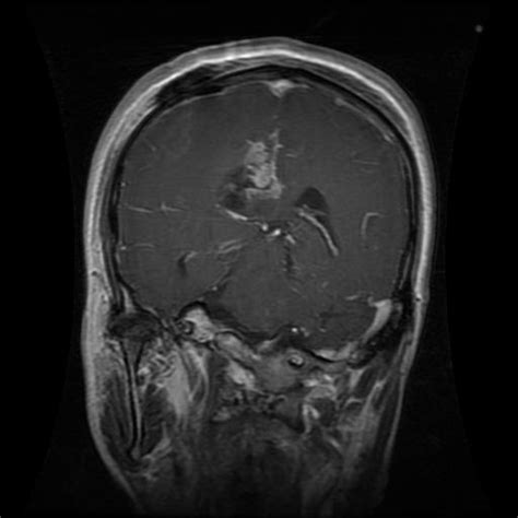 Tumor Classification And Localization Object Detection Model By Ali Rehman