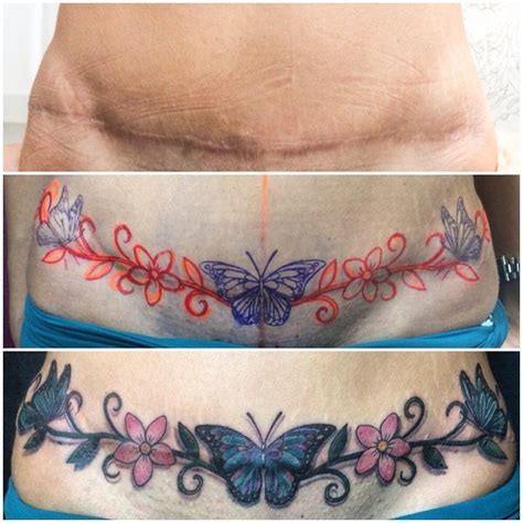 Tummy Tuck Scar Camouflage Tattoo Forearm Tattoo Ideas