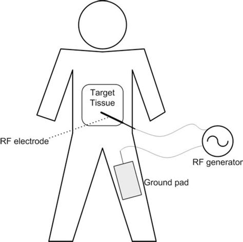 Overview Of An Rf Ablation Procedure A Rf Electrode Is Inserted Into