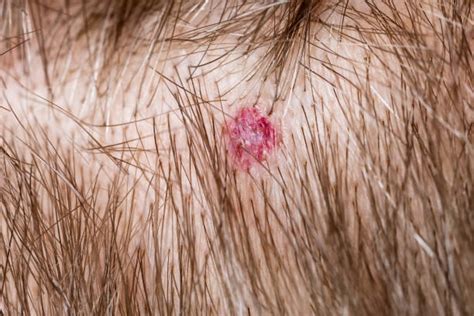 Moles On Scalp