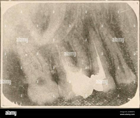 Upper Third Molar Root Infection