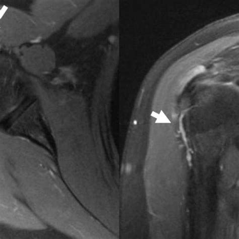 Hill Sachs Defect Coronal Sagital And Transversal T1 Weighted