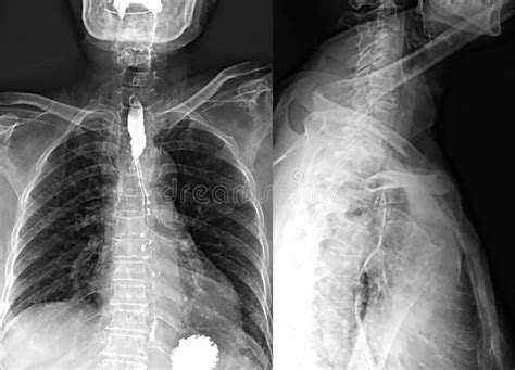 Fluoroscopic Footage Of A Barium Swallow Test Showing Real Time