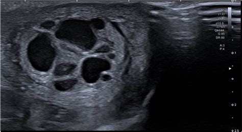 Neonatal Juvenile Granulosa Cell Tumour A Rare Entity Anales De