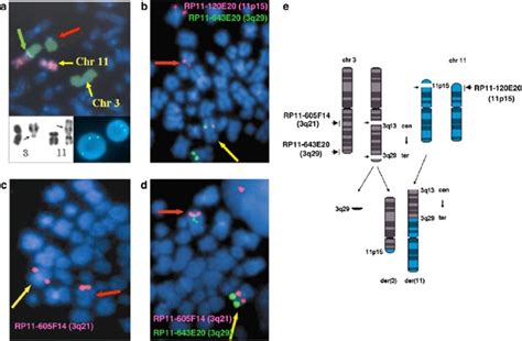 A New Fusion Gene Nup98 Iqcg Identified In An Acute T Lymphoidmyeloid