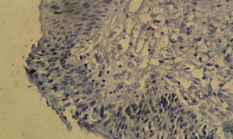 9 Normal Urothelium Showing The Negative Immunohistochemical