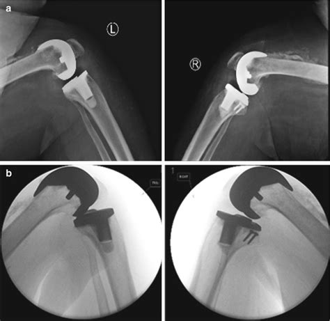 Operative Procedure For Primary Tkr How To Increase Rom Musculoskeletal Key