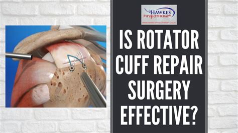 Rotator Cuff Tear Singapore Orthopaedic Surgeon