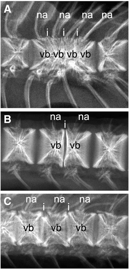 Congenital Hand Deformities Semantic Scholar