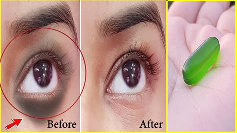 Apply Vaseline On Your Under Eye Dark Circles And See The Magic