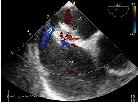 A Transesophageal Echocardiogram Demonstrating A Deployed Occluding
