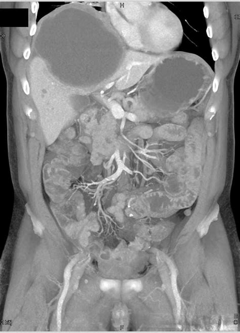 Cystic Cholangiocarcinoma Liver Case Studies Ctisus Ct Scanning