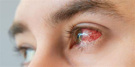 Conjunctivitis Styes Eyelid Infection Etc The Most Common Eye