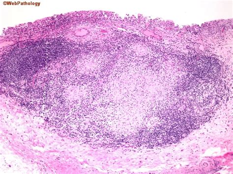 Granulomatous Cystitis Post Bcg