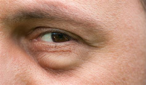 Key Elements Of Lower Eyelid Surgery