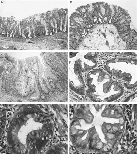 Sessile Serrated Polyps Contain Elongated Crypts A That Show Download Scientific Diagram
