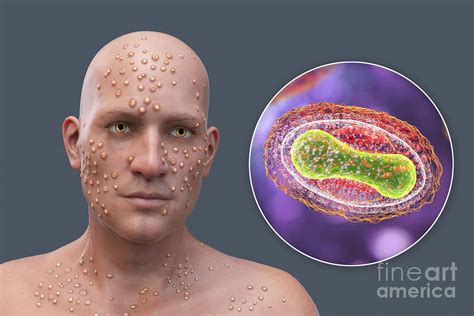 Smallpox Virus Infection 3 By Science Photo Library