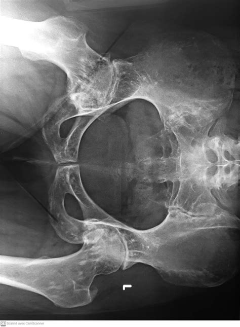 X‐ray Of The Pelvis Demonstrating A Grade 3 Right Sacroiliitis A Grade